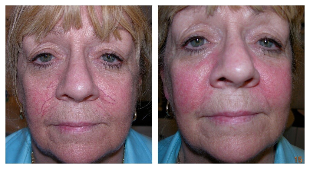 Thread/Spider Veinwave Removal Essex | Elan Medical Skin Clinic Essex