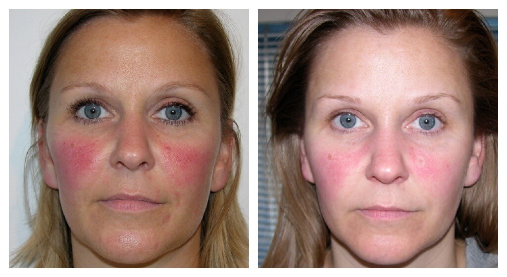 Rosacea Treatment |Essex | Elan Medical Skin Clinic in Rayleigh Essex